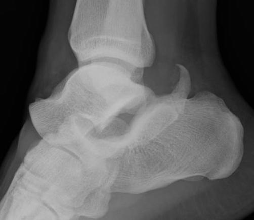 Subtalar Dislocation | The Bone School